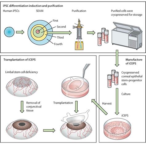 Successful Transplant Of Hips Cell Derived Corneal Epithelium In Lancet