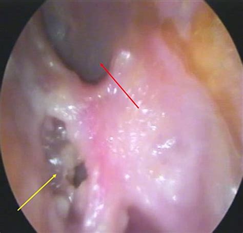 Frontiers Expanding The Diagnostic Spectrum Of Malignant Otitis