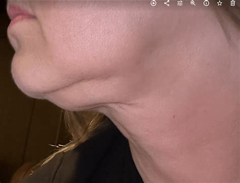 Best Treatment For Sagging Jowls And Skin Tightening R Medspa