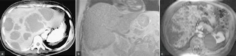 Pyogenic Multiple Liver Abscessesa Contrast Enhanced Ct Scan Shows