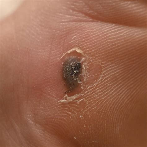 Is This Melanoma Or A Scab Rmelanoma