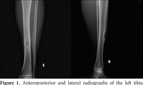 Figure 1 From A Rare Case Of Adamantinoma In Tibia And Radiological