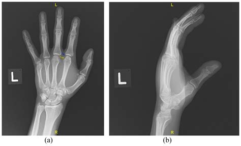 Xray Demonstrating A Rare Volar Metacarpophalangeal Joint Dislocation