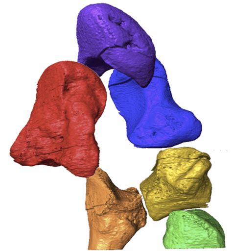 Three Dimensional 3d Segmentation Of Wrist Bones Prior To Volume Of