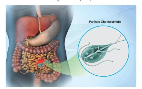 A giardíase infecção intestinal causada por um protozoário flagelado