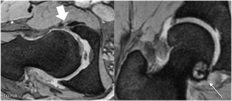 Osteoid Osteoma Of The Femoral Head Treated By