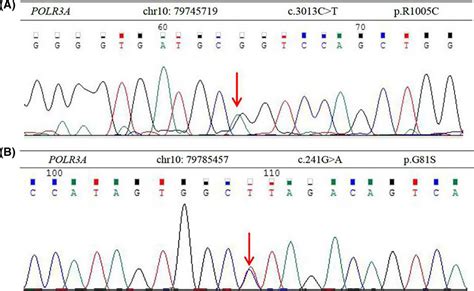 A Heterozygous Missense Mutation In Exon 23 Of Polr3a Gene C 3013c T Download Scientific