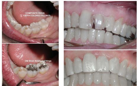 What Is Resin Filler At Jordan Old Blog