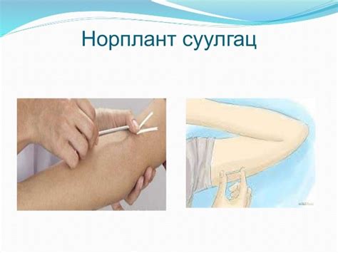 Гоодаль эмнэлэг Жирэмсэлтээс хамгаалах Арьсан доорх суулгац буюу