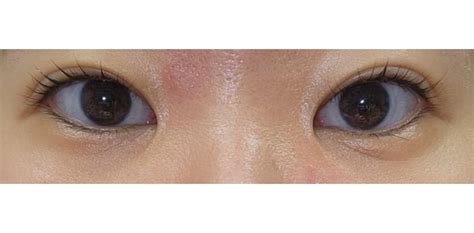 리얼후기 5 페이지 눈이 예쁘다그래서 아몬드성형외과