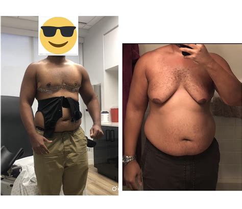1 Week Post Op Results Severe Gyno Rgynecomastia