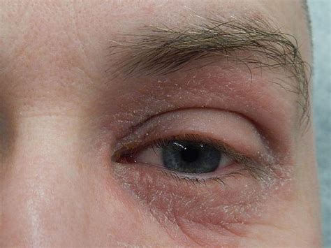 Periocular Dermatitis Around Eyes