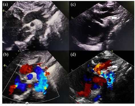 Suprasternal Echocardiogram In Normal Control A And B The Download Scientific Diagram