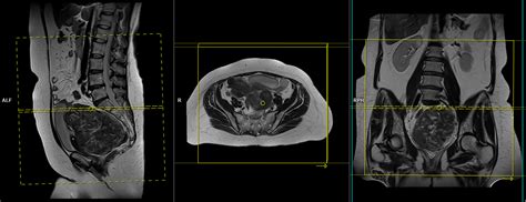 Uterine Fibroid Mri Protocol Fibroid Mapping Mri Protocol And Planning