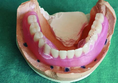 C Abutment Housings Were Secured With Autopolymerizing Acrylic Resin Download Scientific Diagram