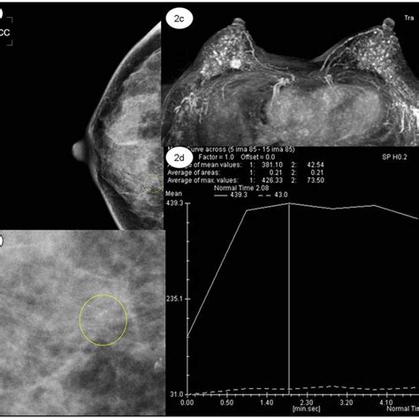 Ab Left Media Lateral Oblique View Mammogram Of Amorphous