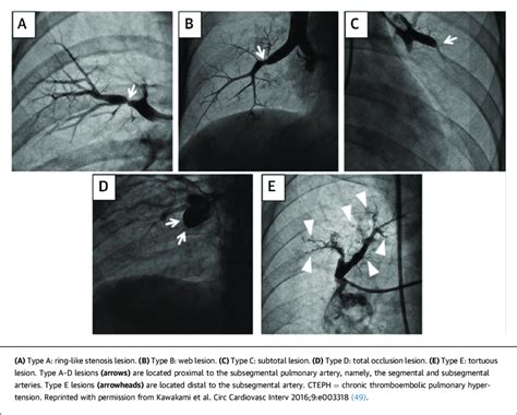 Novel Angiographic Classification Of Cteph Lesions Download Scientific Diagram