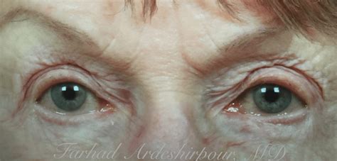 Eyelid Ptosis Surgery External Approach Overview Cost Recovery