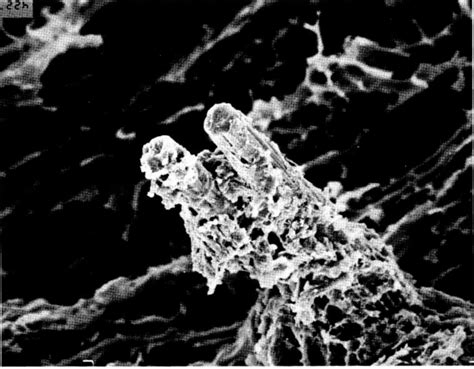 Carbon Fibers Closely Associated With Fibrocytes And Collagen Sem