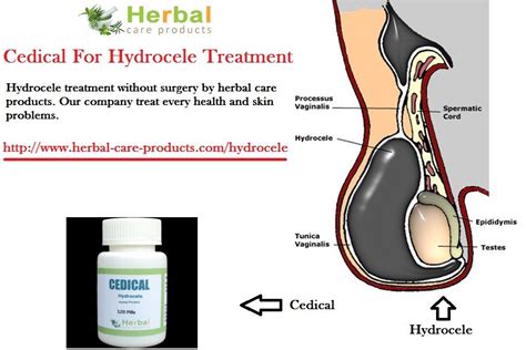 Hydrocele Treatment Without Operation