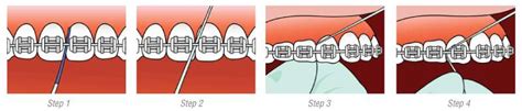 Flossing Diagram Bothell Orthodontics