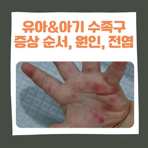 유아 And 아기 수족구 증상 및 원인 초기증상 순서 전염기간 네이버 블로그