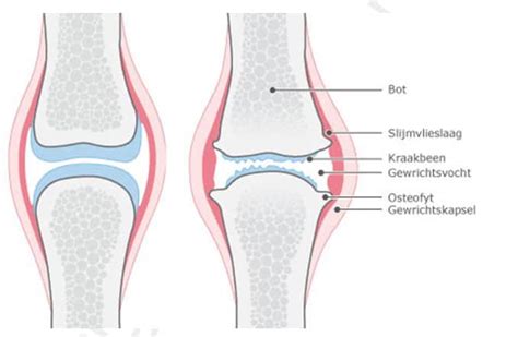 Arthrosis Explained Swiss Point Of Care