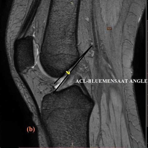 Illustrations Showing Measurement Of Aclinclination Angle