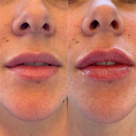 Lip Filler Migration Deep Dive What It Is And What To Do — Maui Medspa