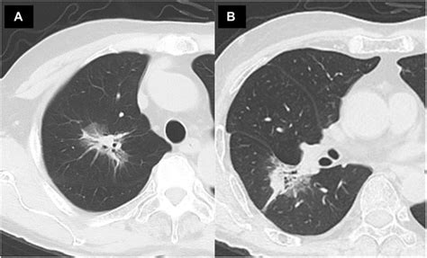 Postoperative Outcome Of Procedure For Middle Lobe Torsion Involving Right Upper And Lower