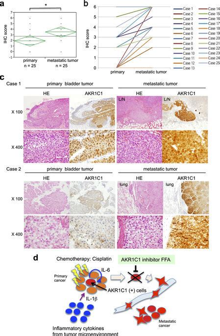 Increased Akr1c1 Expression In Human Metastatic Tumors Akr1c1