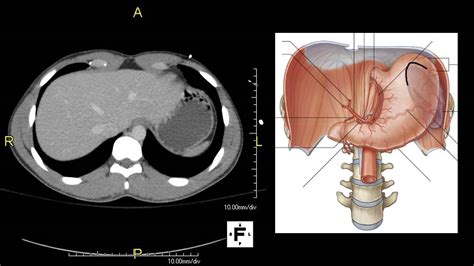 Axial Ct Abdomen Youtube