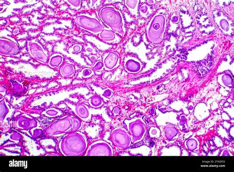 Micrograph Of Prostatic Hyperplasia Showing Increased Glandular Tissue