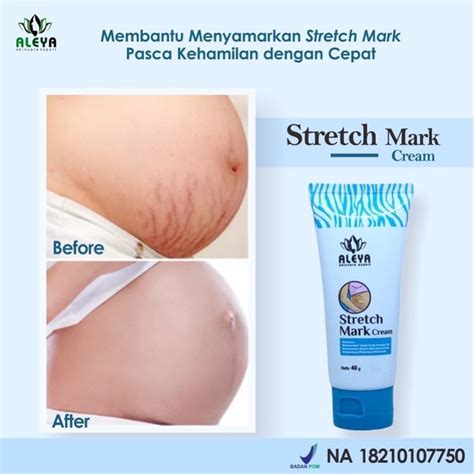 Jual Aleya Strechmark Cream Penghilang Bekas Luka Keloid Obat Strechmark Obat Penghilang Selulit