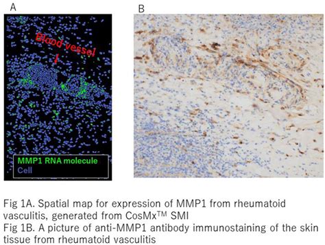 Ab0167 Single Cell Spatial Transcriptome Analysis Identifies Disease Specific Fibroblasts In