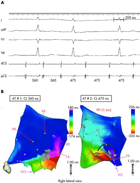 Dual Loop Atrial Macro Re Entrant Tachycardia In A 62 Year Old Patient