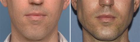 Widening Jaw Angle Implants Result Front View Dr Barry Eppley Indianapolis Explore Plastic Surgery