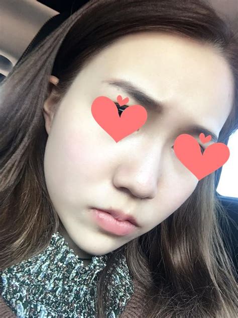 線雕隆鼻就半個多月自然得都不覺得是做的了 每日頭條