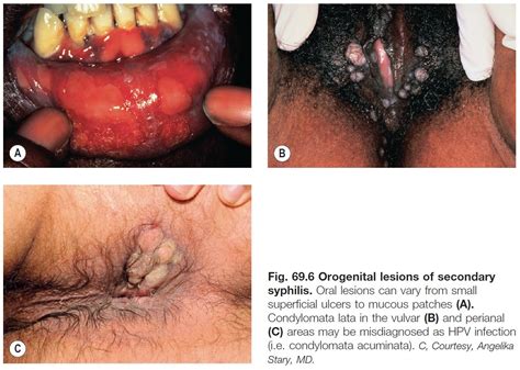 Condyloma Lata Vs Condyloma Accuminata
