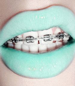 Braces Tumbex