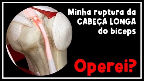 Liquido Na Bainha Do Tendão Da Cabeça Longa Do Biceps BRAINCP