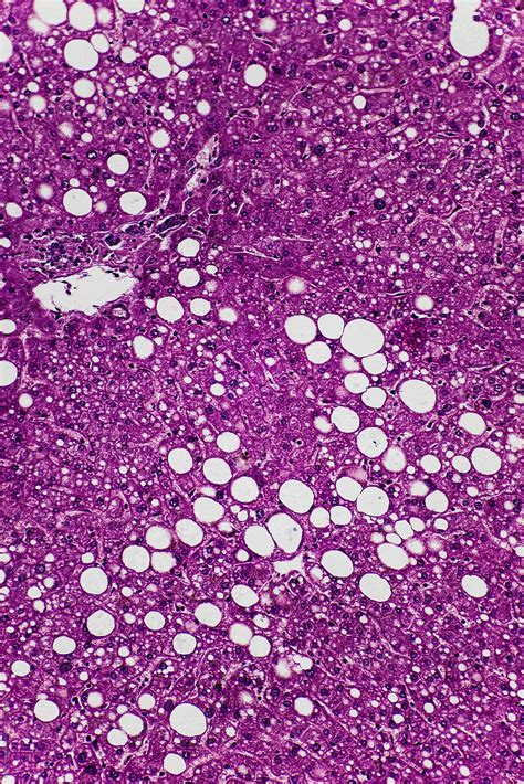 Human Liver Tissue Showing Fatty Degeneration By Stocksy Contributor