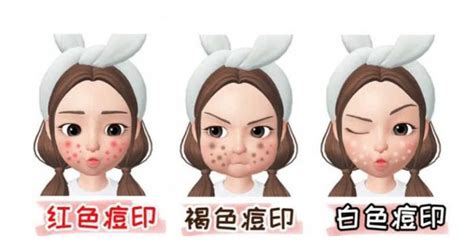 常见的痘印分4种红痘印要防晒黑痘印要美白你做对了吗