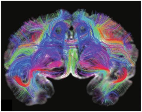 20 Diffusion Spectrum Imaging Coronal Cross Section Of The Fibers Download Scientific Diagram