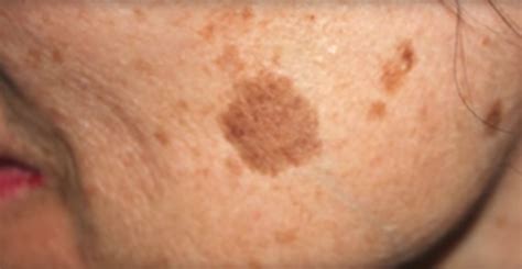 Brown Spots Suddenly Appearing On Skin Diabetes Printable Templates