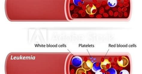 What Are The Different Types Of Leukemia