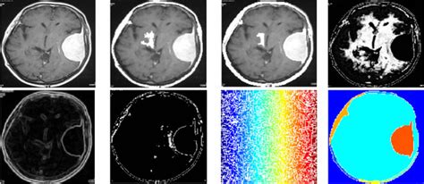 Simulation Results Of Cerebrum Tumor Segmentation Using Proposed Method Download Scientific