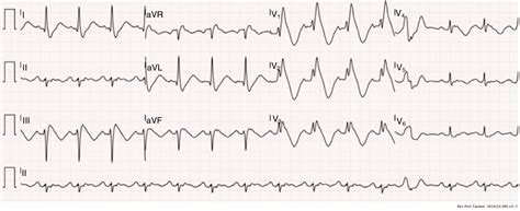 Epicardial Ablation For Prevention Of Ventricular Fibrillation In A Patient With Brugada