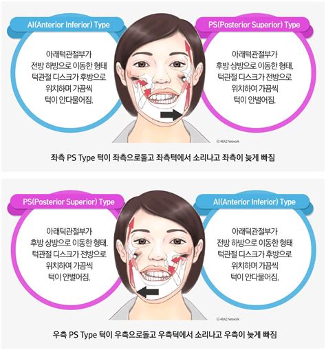 Cfrt 두개안면교정술 포바즈 교정시스템