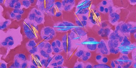Systematic Review Suggests Synovial Fluid Analysis When Necessary For
